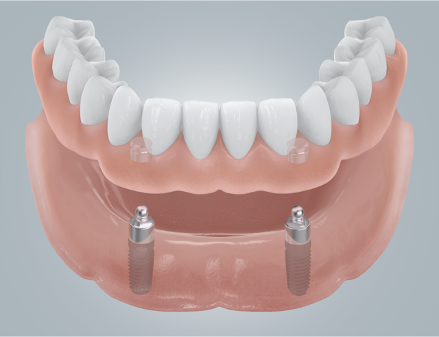 Implantologie - Tandarts Putten